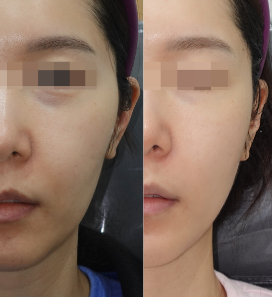 Understanding Juvelook Volume: Effects and Timeline – Gangnam Tatoa ...